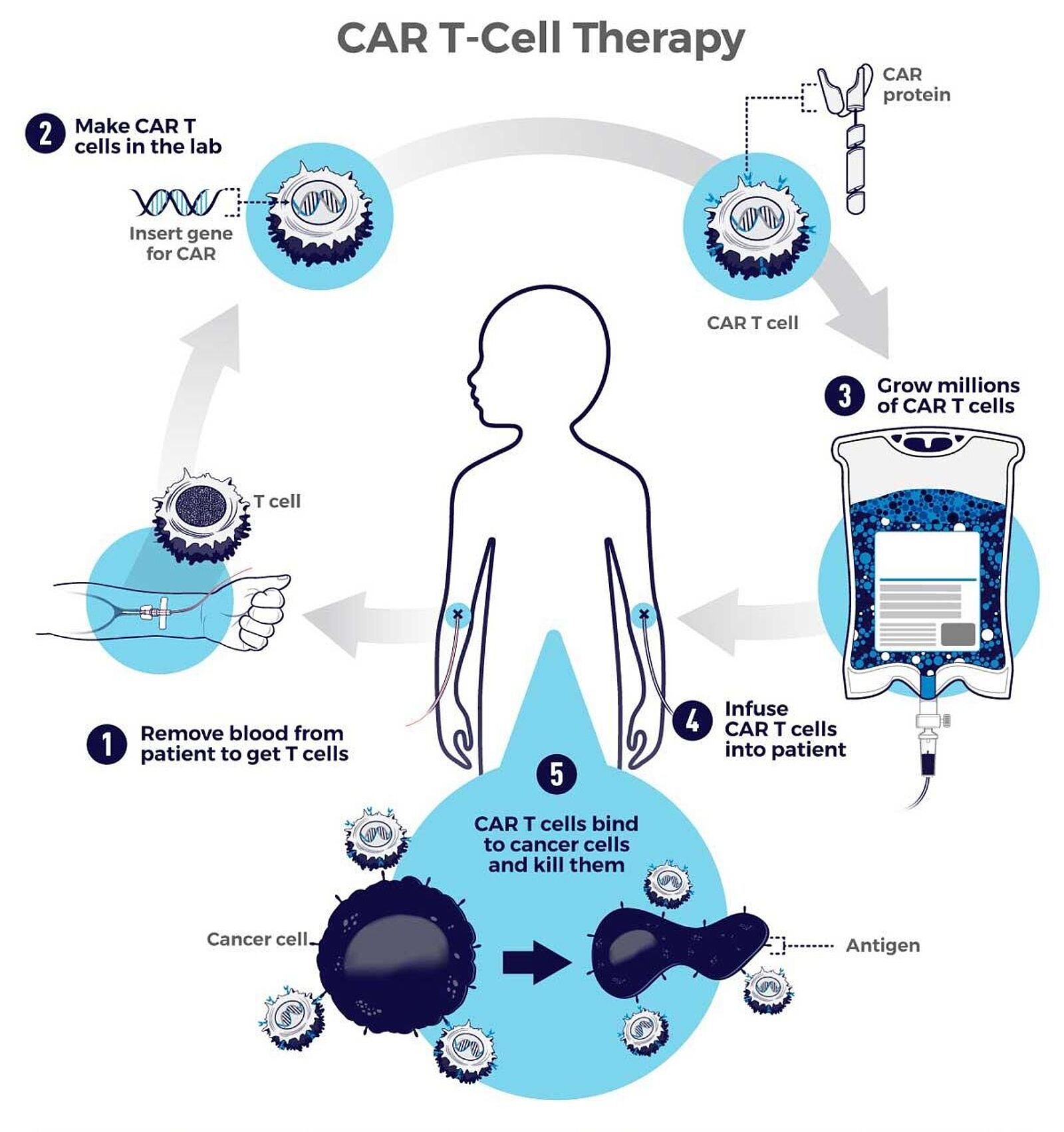 CAR T Cell Therapy - How does it work? - Read our Blog